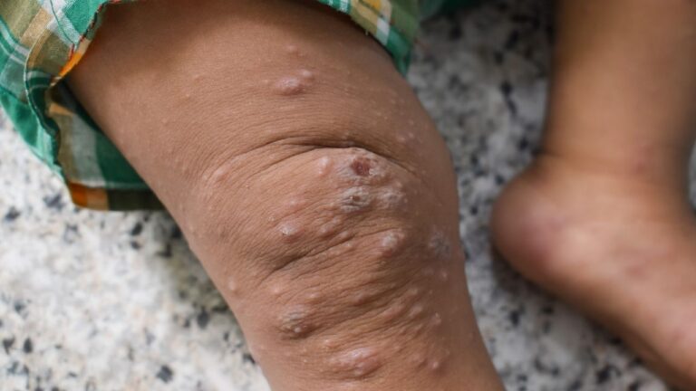 Officials report Ethiopia’s first mpox cases in Moyale